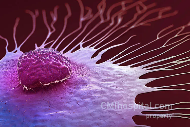 Kanker - Biopsi Menyebabkan Sel Kanker Menyebar?? - Cmihospital